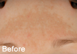 Depigmenting Peel Dorset, Chemical Skin Peel Bournemouth, Multi Enzyme ...